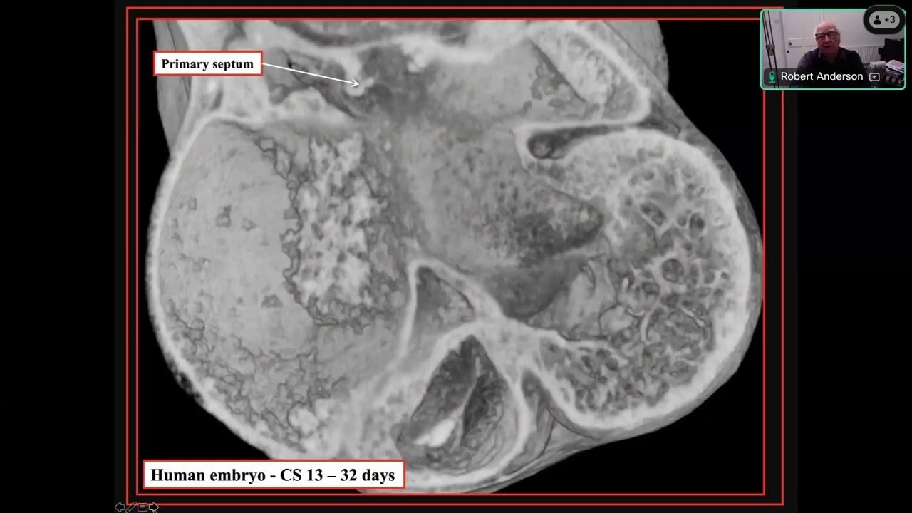 Anatomy Session #6: Functionally Univentricular Heart