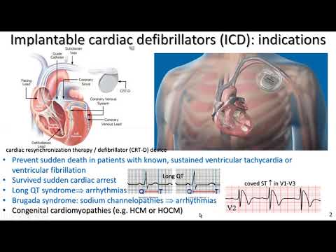 Permanent pacemakers and implantable cardiac defibrillators for exercise pros part 2: ICD:the basics