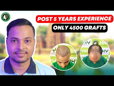 Best Hair Transplant in Odisha | Best Hair Transplant Result & Cost in Odisha