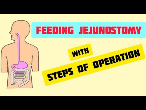Feeding Jejunostomy | Steps of the procedure