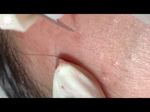 BLACKHEADS AND ACNE REMOVAL #70 | Lấy mụn ẩn dưới da, mụn đầu đen | 黑頭和粉刺去除 | 0934000075