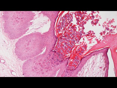 Skin pathology Quiz 13 - Answers