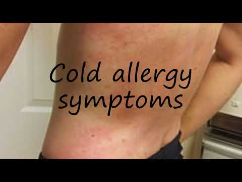 How to pronounce Cold allergy symptoms in English?