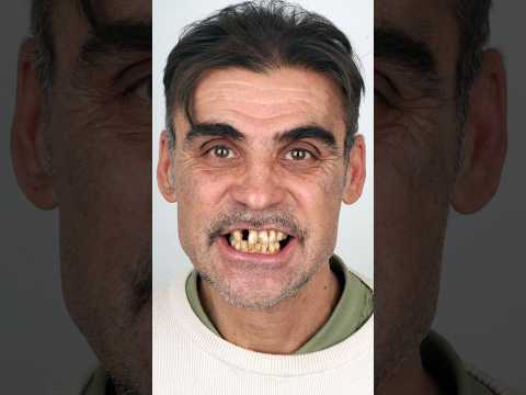 Full Smile Reconstruction with Zirconia Crowns