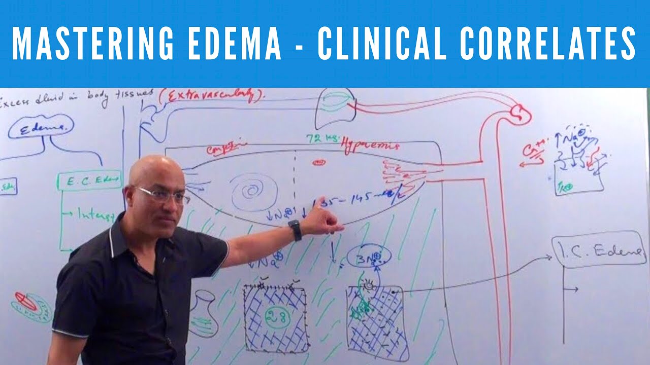 Mastering Edema | Types Causes Symptoms & Treatment 👨‍⚕️