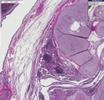 Histopathology Lung--Hamartoma