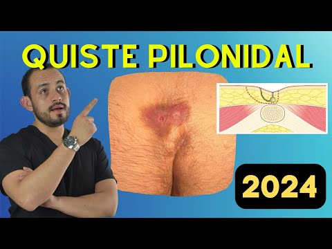 ⚗️ ¿Cuál es el Mejor Tratamiento del 𝗤𝗨𝗜𝗦𝗧𝗘 𝗣𝗜𝗟𝗢𝗡𝗜𝗗𝗔𝗟?