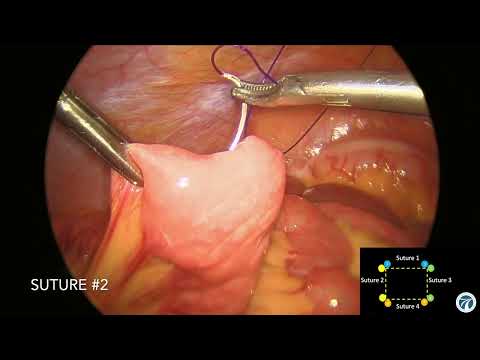 Laparoscopic Feeding Jejunostomy Tube Placement