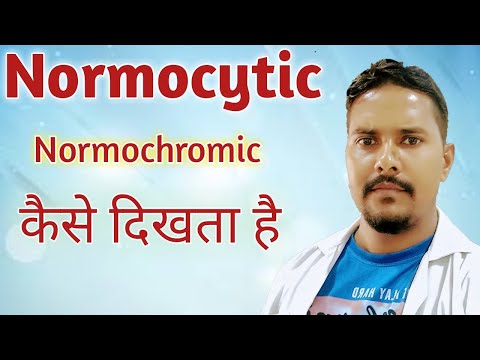 normocytic normochromic in hindi | Normocytic anemia | RBC indices in hindi