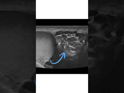 Varicocele on ultrasound