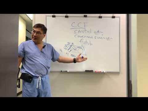 Carotid Cavernous Fistula Laterality