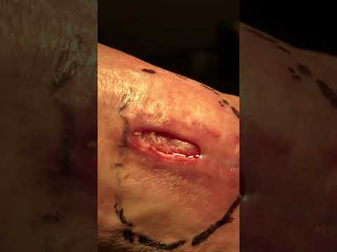 Surgical Wound Dehiscence