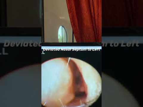 Deviated nasal septum to left seen on Diagnostic nasal endoscopy