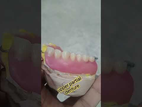 upper partial denture 😁😁😁#dentist #artificialteeth #splittooth #orthodontist #teethwhiting