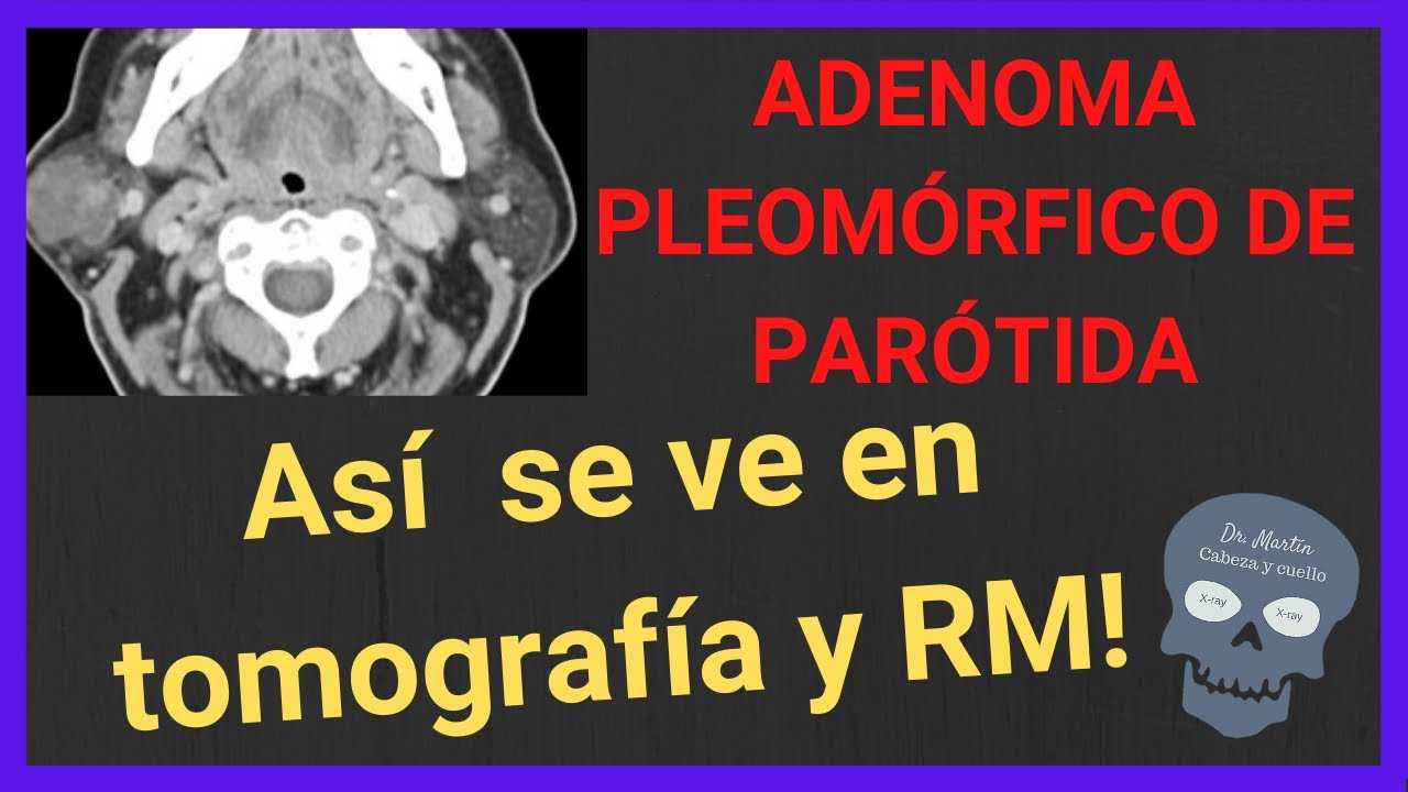 Pleomorphic adenoma of the parotid gland (on CT and MRI)