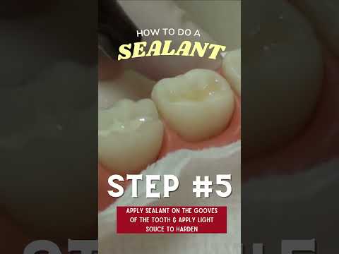 Sealant Procedure: Apply and Harden the Sealant | In Office to Hands On Dental Training