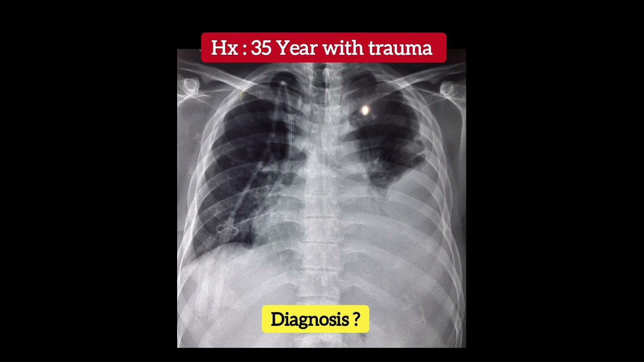 Chest X Ray practice case  15 - ? Diagnosis