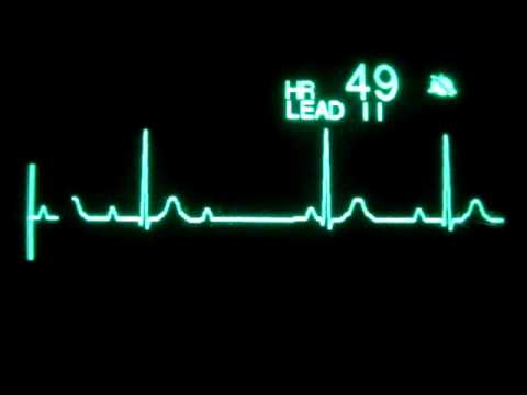2nd Degree Atrioventricular Block Type I, Mobitz I, Wenckebach