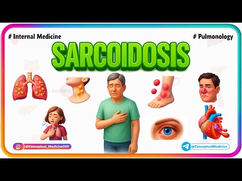 10. Sarcoidosis | Must-Know Internal Medicine Topic for NEET PG/FMGE/USMLE ????
