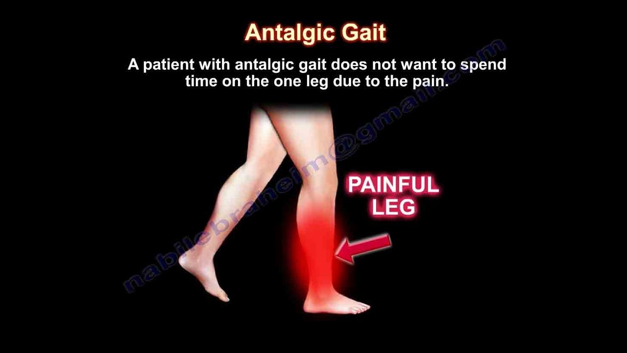 Antalgic Gait - Everything You Need To Know - Dr. Nabil Ebraheim