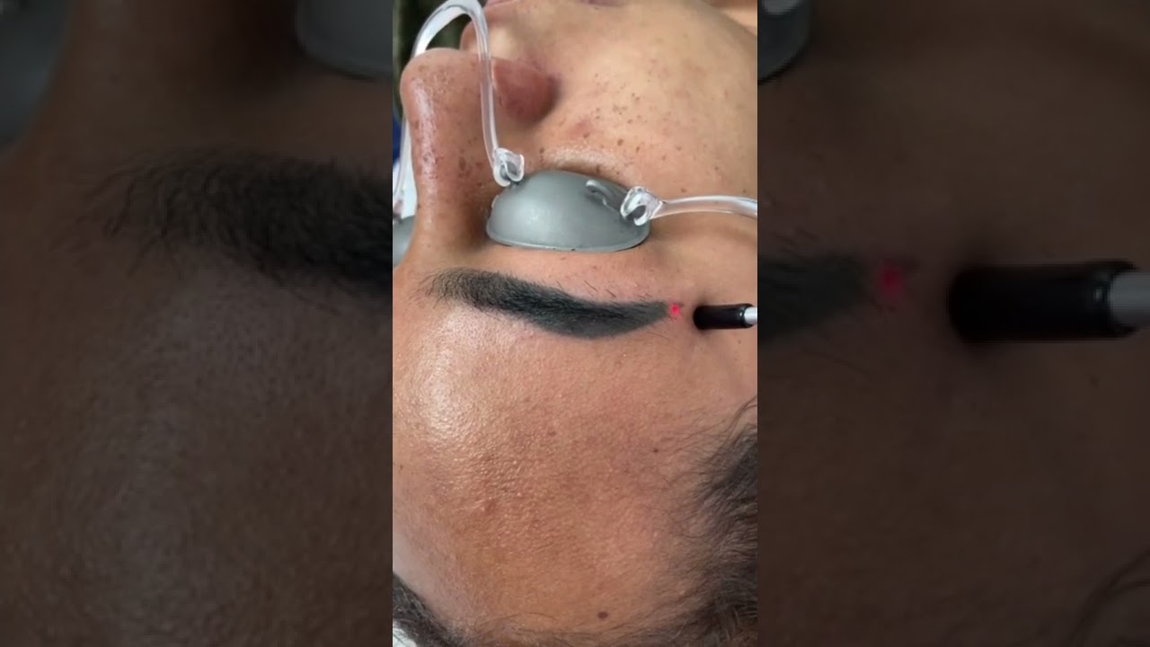 Brow Tattoo Removal