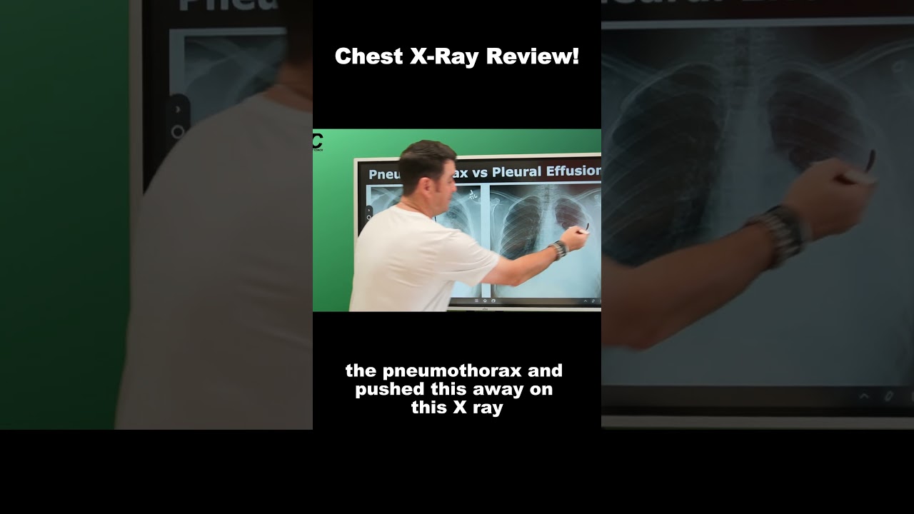 Chest X-RAY Review