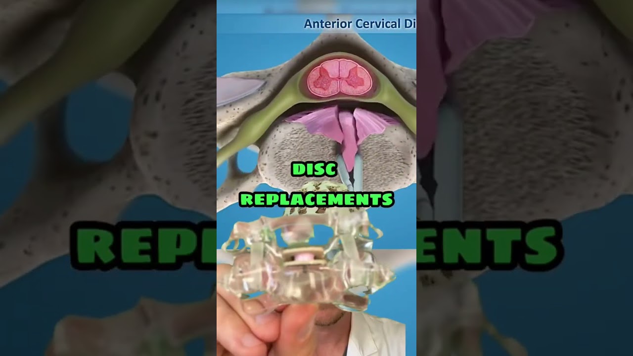 𝟮𝟬𝟮𝟯: 𝗯𝗶𝗴𝗴𝗲𝘀𝘁 𝘁𝗿𝗲𝗻𝗱 𝗶𝗻 𝘀𝗽𝗶𝗻𝗲 𝗶𝘀 𝗗𝗜𝗦𝗖 𝗥𝗘𝗣𝗟𝗔𝗖𝗘𝗠𝗘𝗡𝗧𝗦!