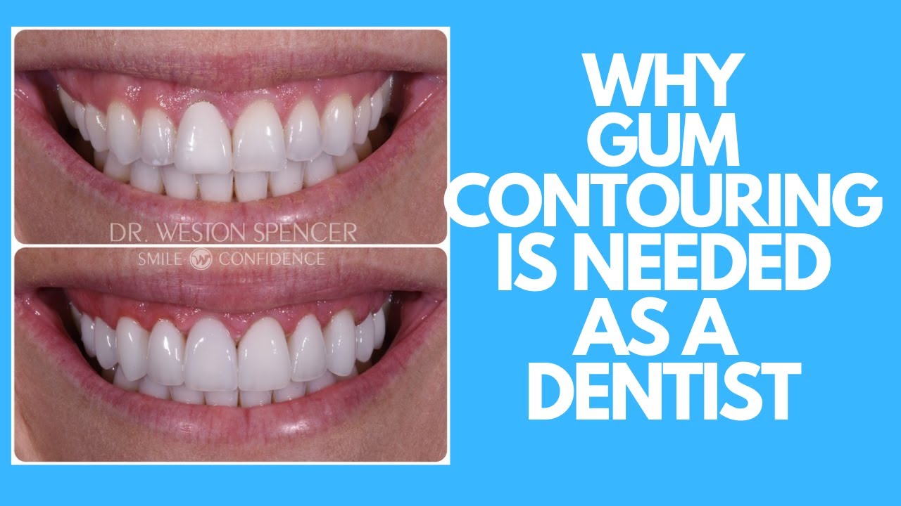Why Gum Contouring is Needed As a Dentist!