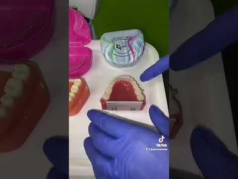 Type of retainers after braces