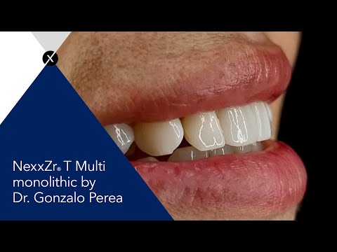Sagemax experience: NexxZr T Multi monolithic by Dr. Gonzalo Perea