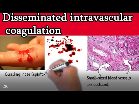 Disseminated intravascular coagulation (DIC) - Causes, Symptoms, Treatment and prognosis