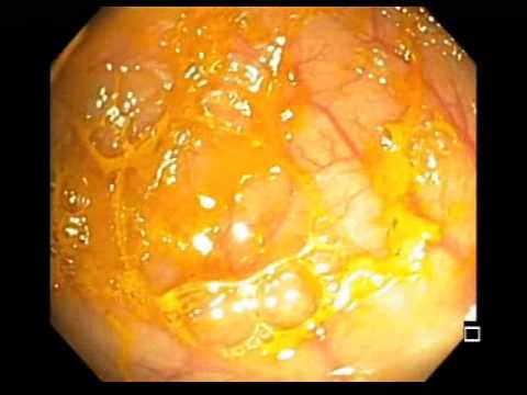 Normal Cecum, Appendiceal Oriface and Terminal Ileum