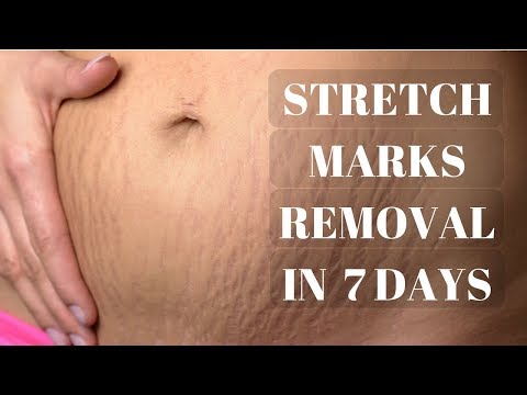How to Get Rid of Stretch Marks Naturally Fast | Stretch marks removed ...