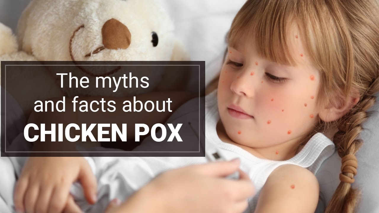 The Myths and Facts about Chicken Pox