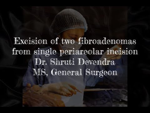 Two fibroadenomas removed from single periareolar - Best possible cosmetic result in this scenario