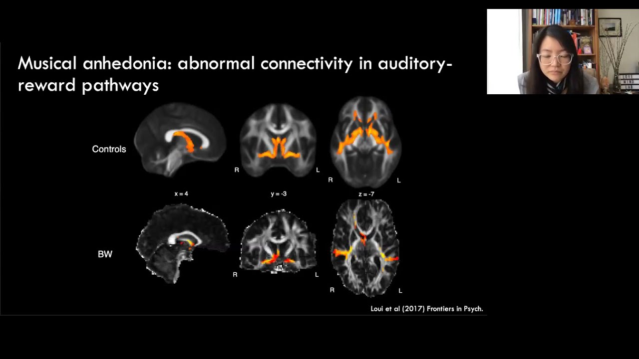 NU@Noon: Music-Based Interventions for Brain Health