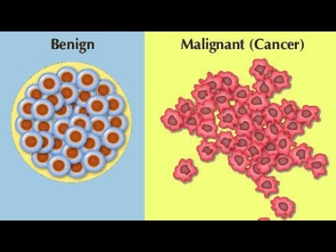 Benign tumor vs malignant tumor hindi