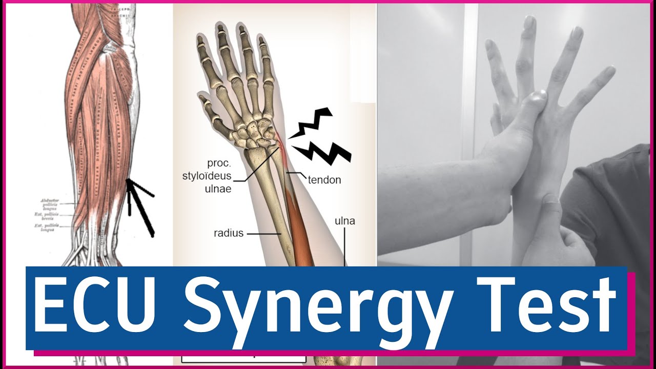 ECU Synergy Test | ECU Tendinopathy