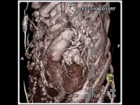 Cardiac: aneurysm of the ascending aorta and the arch (1 of 8)