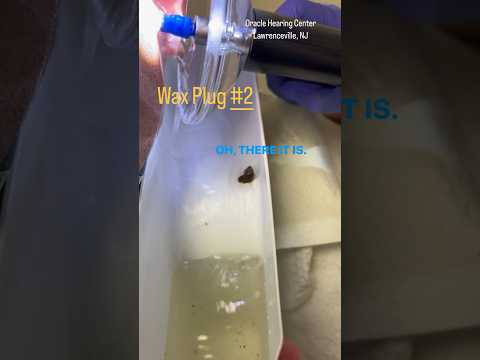 Large plugs of earwax? No wonder his hearing was muffled..