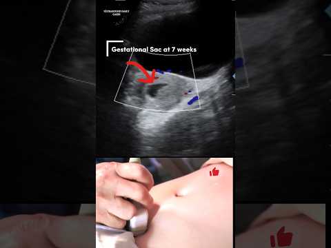 Vaginal Bleeding at 7weeks? Ultrasound Reveals Surprising Truth!#shorts #pregnancy #ultrasound