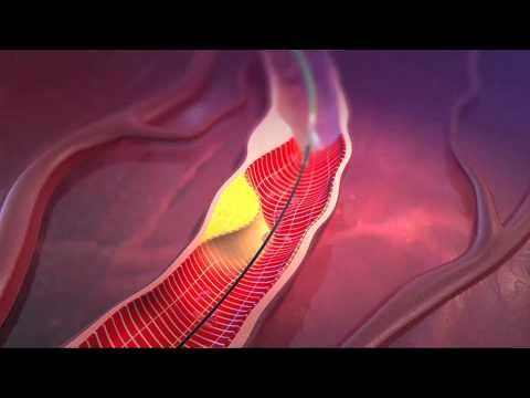 LipiScan Coronary Imaging System