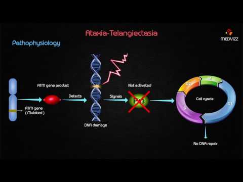 Ataxia-Telangiectasia Syndrome - Usmle case based discussion