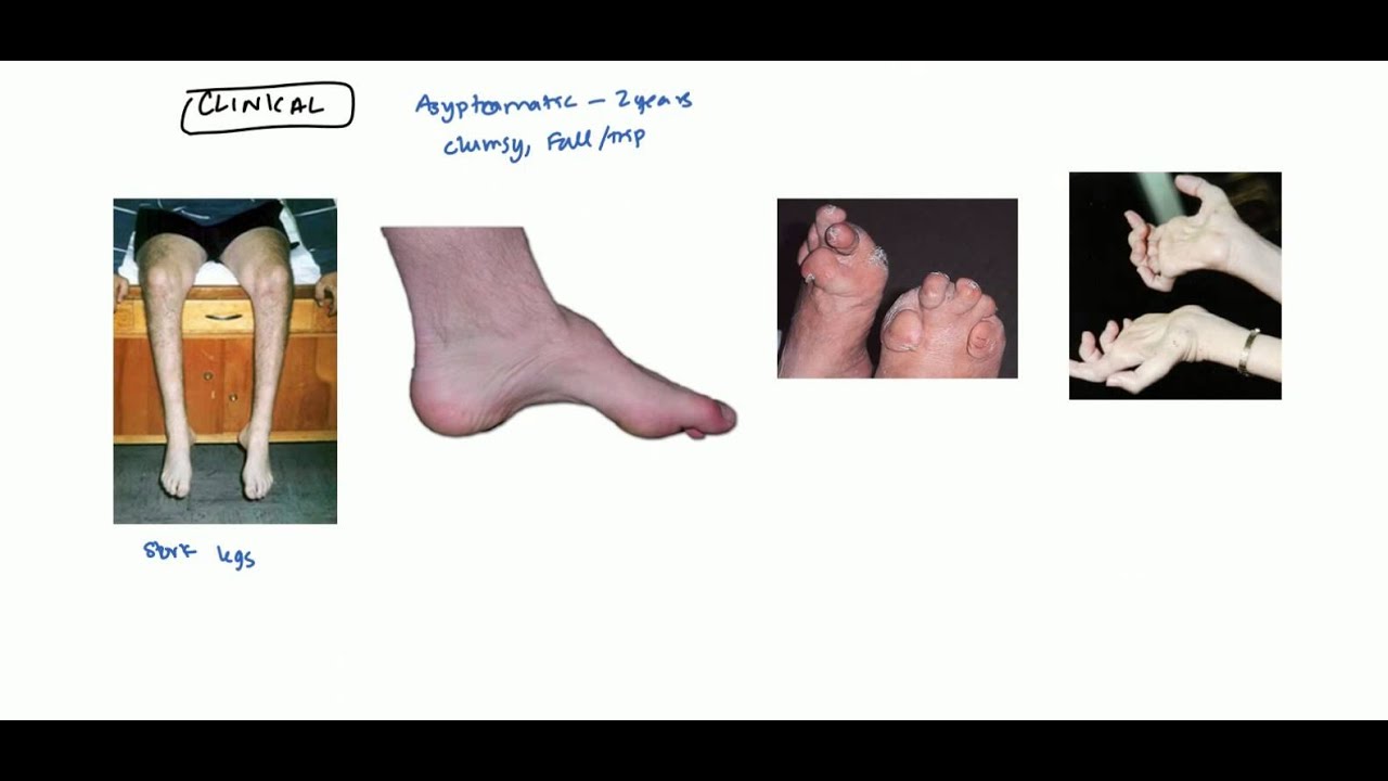 Charcot Marie Tooth Syndrome for USMLE