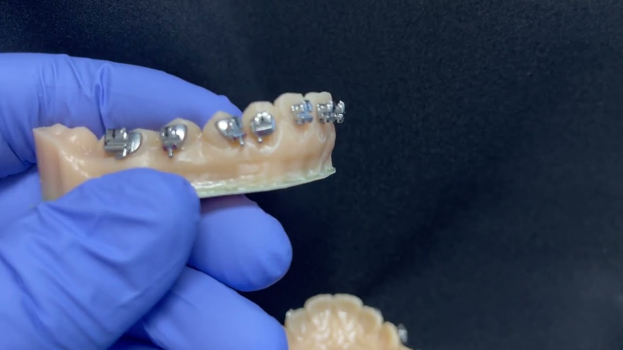 Bracket Placement Protocol For Class 1 Deep Bite