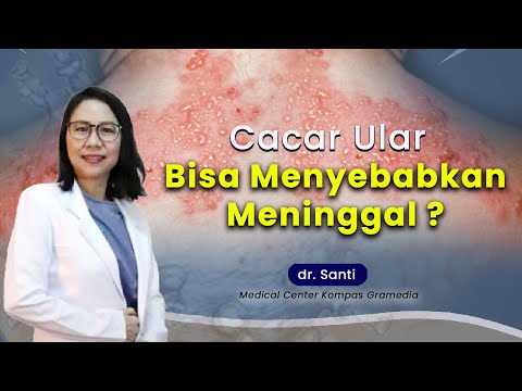 Cacar Ular Bisa Sebabkan Kematian?Ini Jawaban Dokter | Health Corner