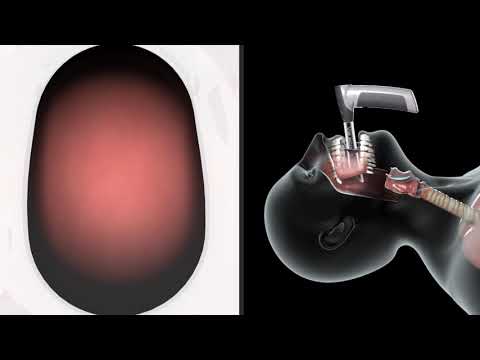 intubation animation 15 sec
