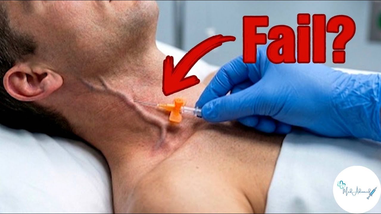 EJV Cannulation Technique That Changes Everything in Emergency Settings