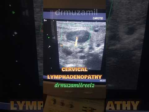 Case 139: Cervical Lymphadenopathy. #neck #ultrasound #lymphnodes #drmuzamilreelz #fy #fypviral