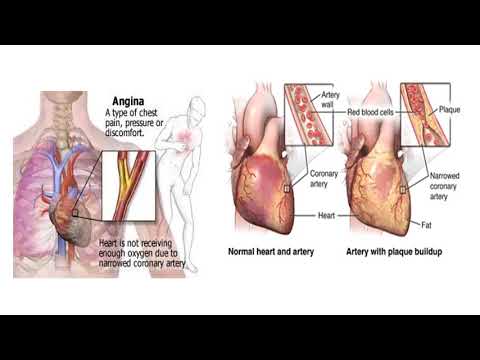 Ischemic Heart Disease Lecture by Dr Nadeem Nusrat